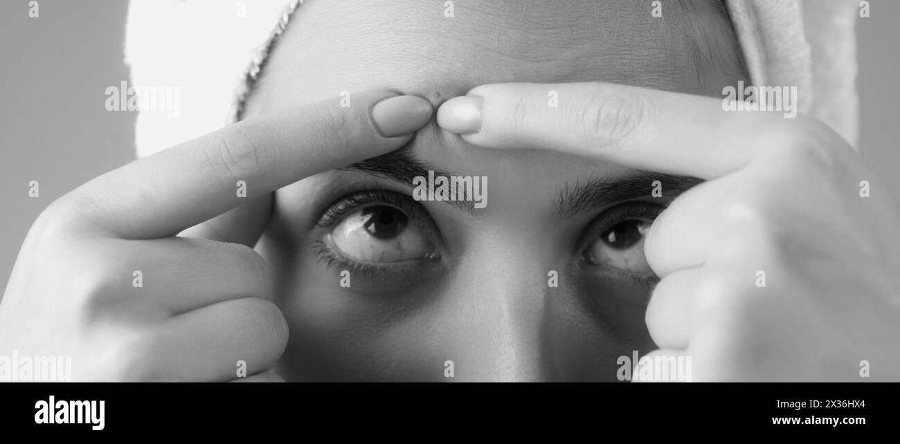 Pustule acne. Close up pimple on female skin. Dermatology, puberty ...