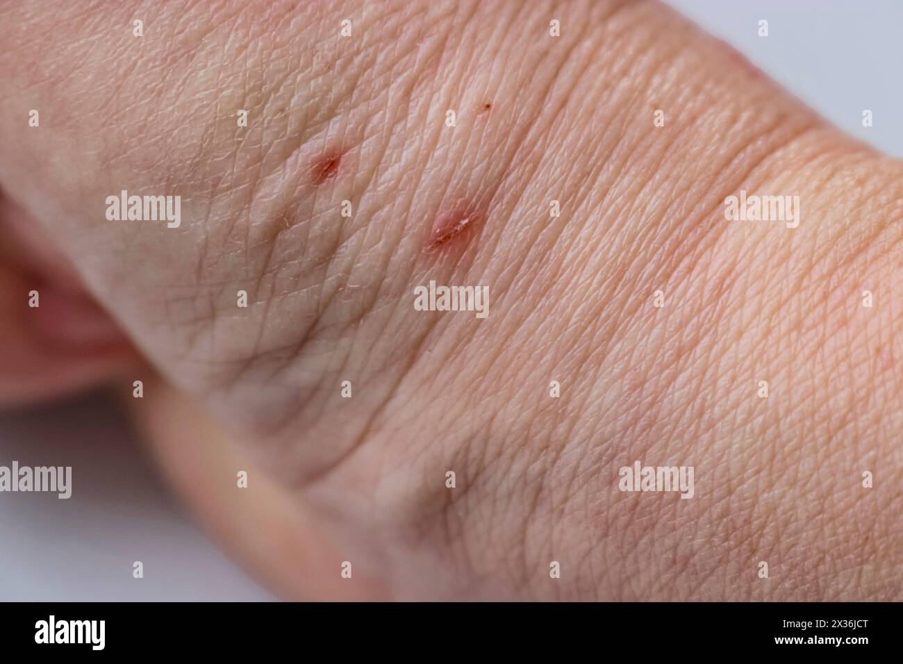 Close-up of scratches on the skin of the wrist. A wound caused by a cat ...