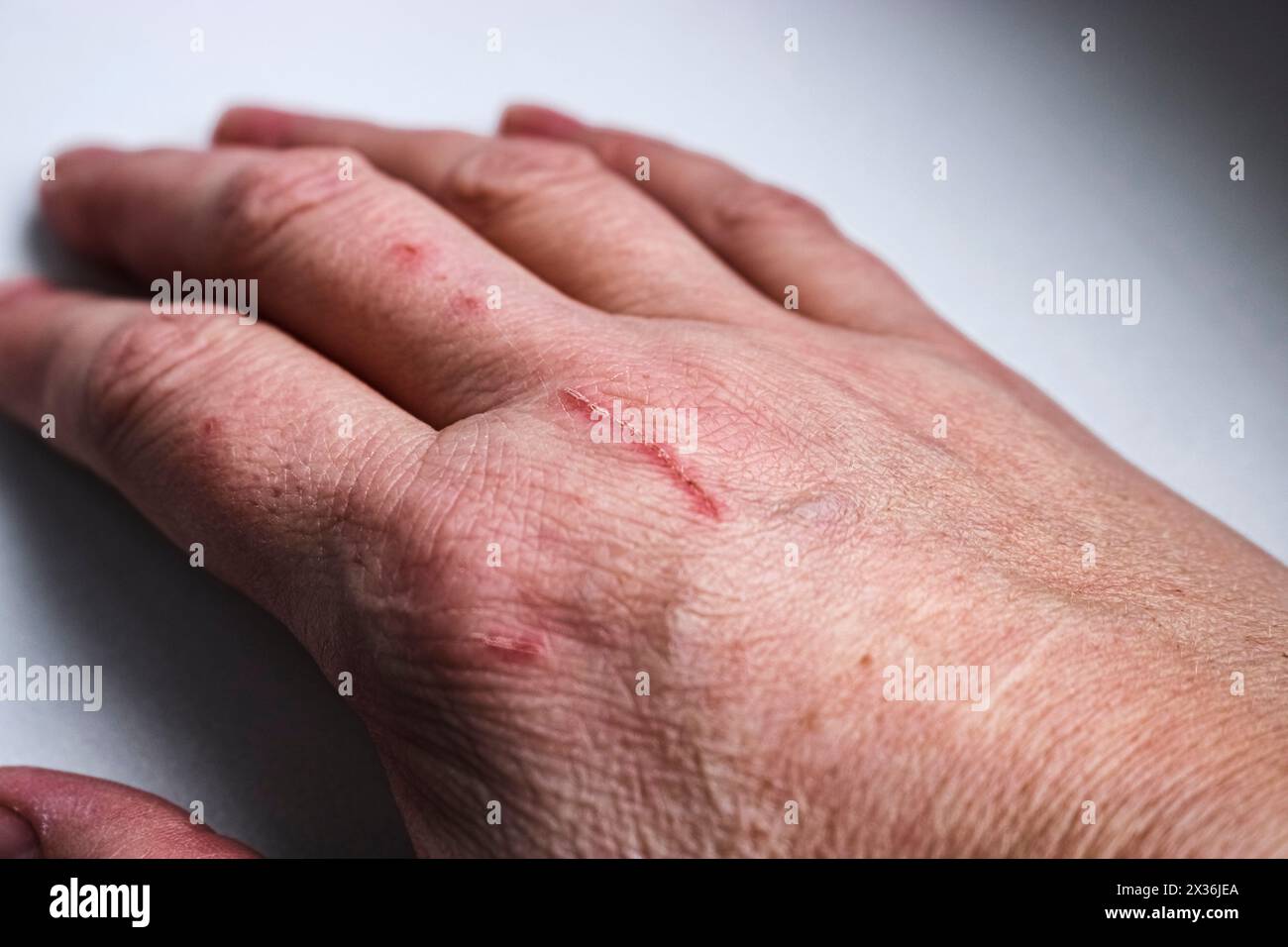 Hand scratched by a kitten. The dangers of cat scratch disease ...