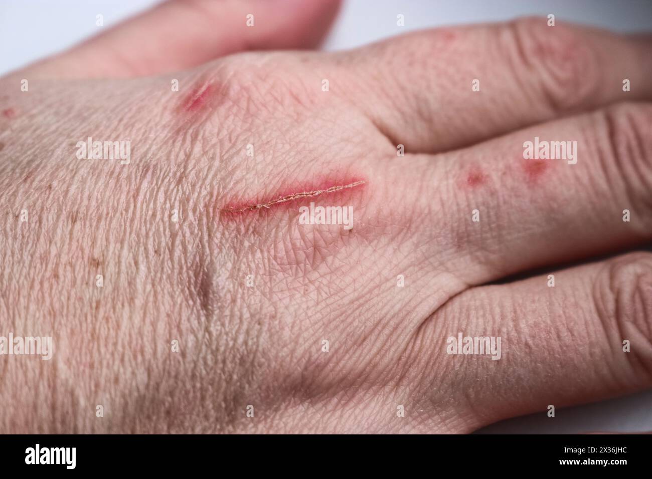 Scratches on the skin close-up. A wound caused by a cat. Selective ...