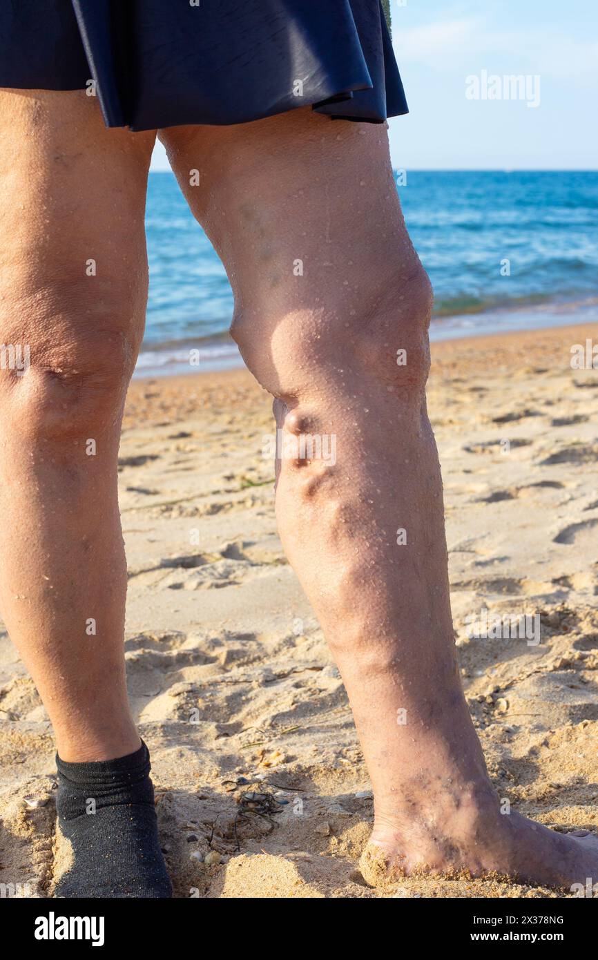 Vertical photo of Sick female legs with thrombophlebitis and bumps ...
