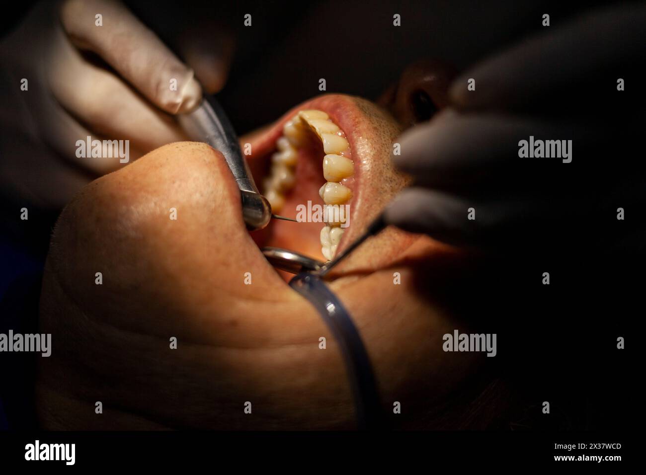 Close up dental examination and treatment, dental cleaning, dental ...