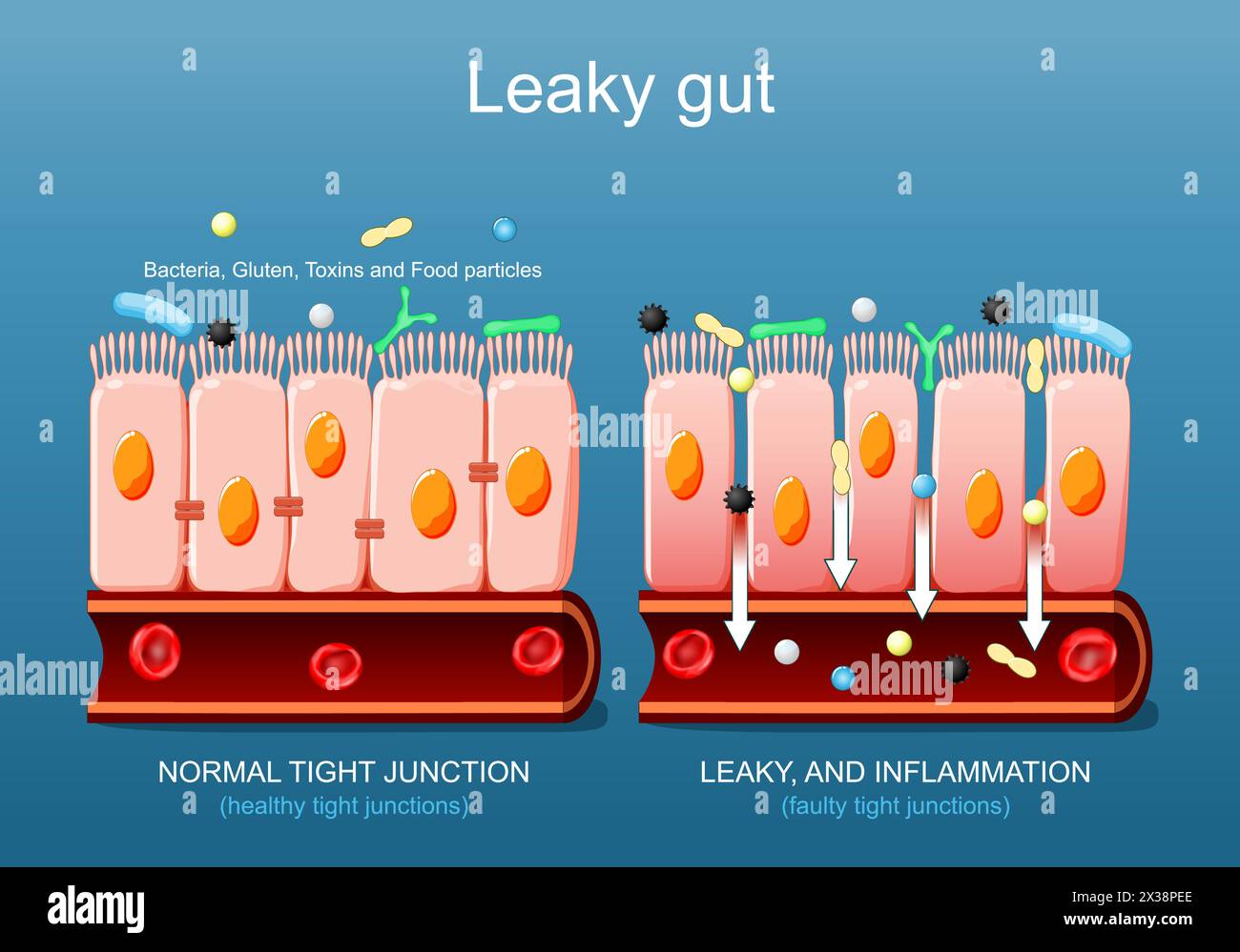 Leaky gut. Close-up of cells of a intestinal epithelium. Difference ...