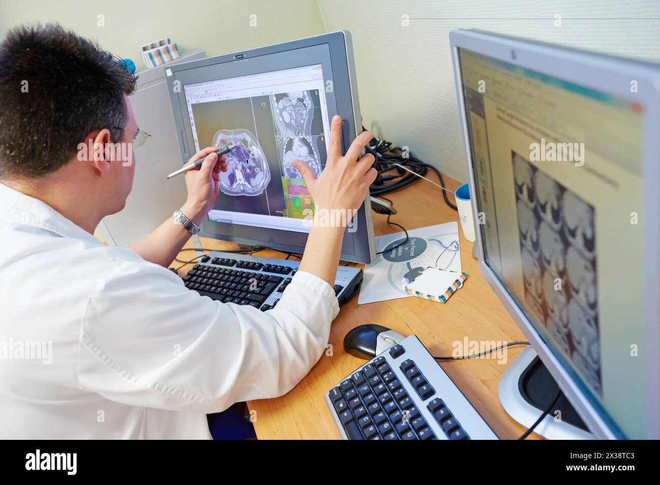 IMRT, Intensity Modulated Radiation Therapy, abdomen Cancer 3D ...