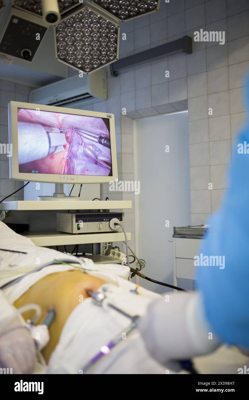 Doctor is removing tumor from abdominal cavity in a display at the ...