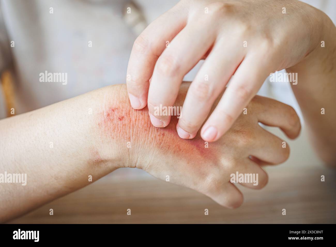Fungal infection skin hi-res stock photography and images - Alamy