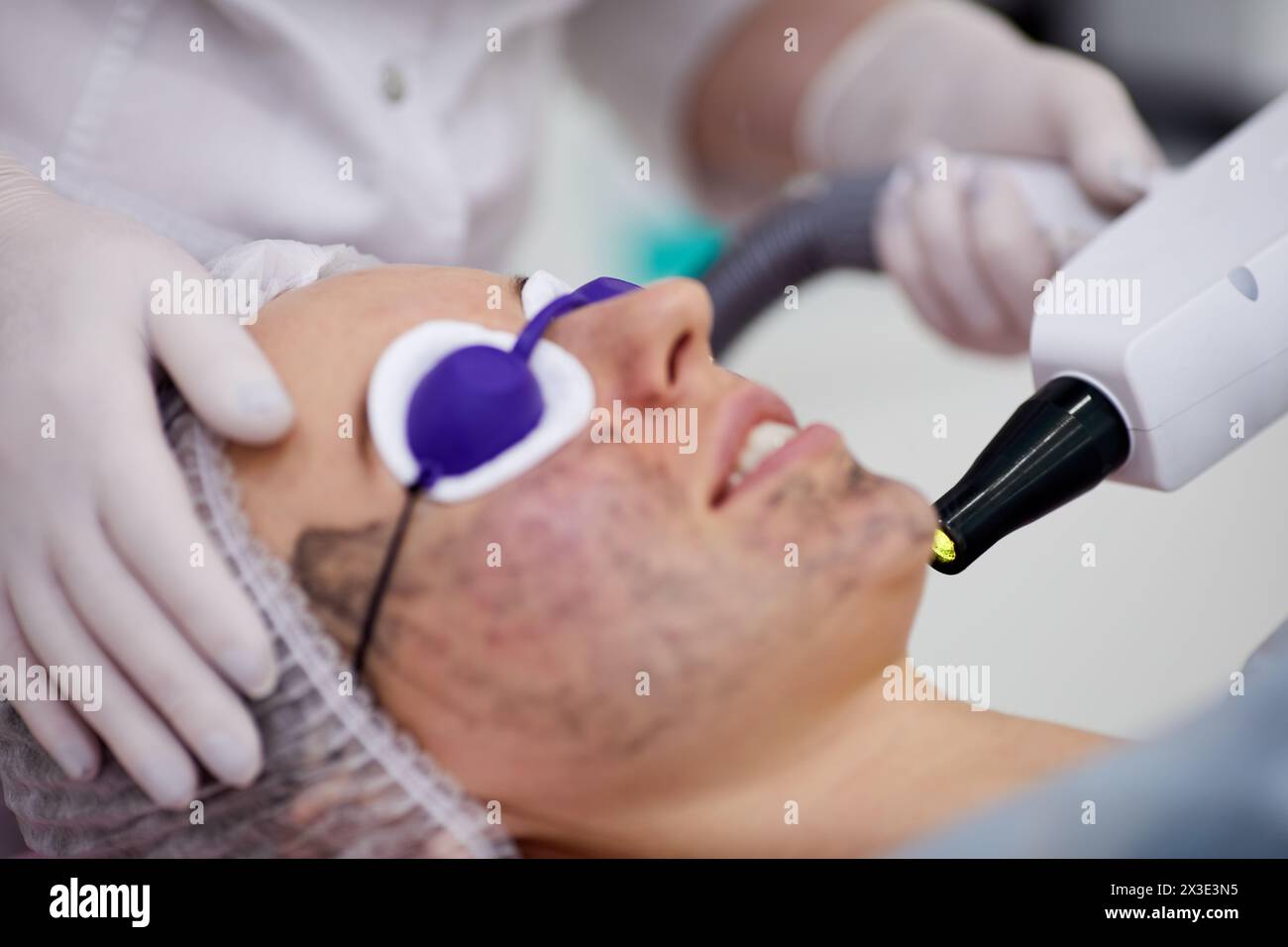 Beautician uses laser for epilate patient face in ccosmetology office ...