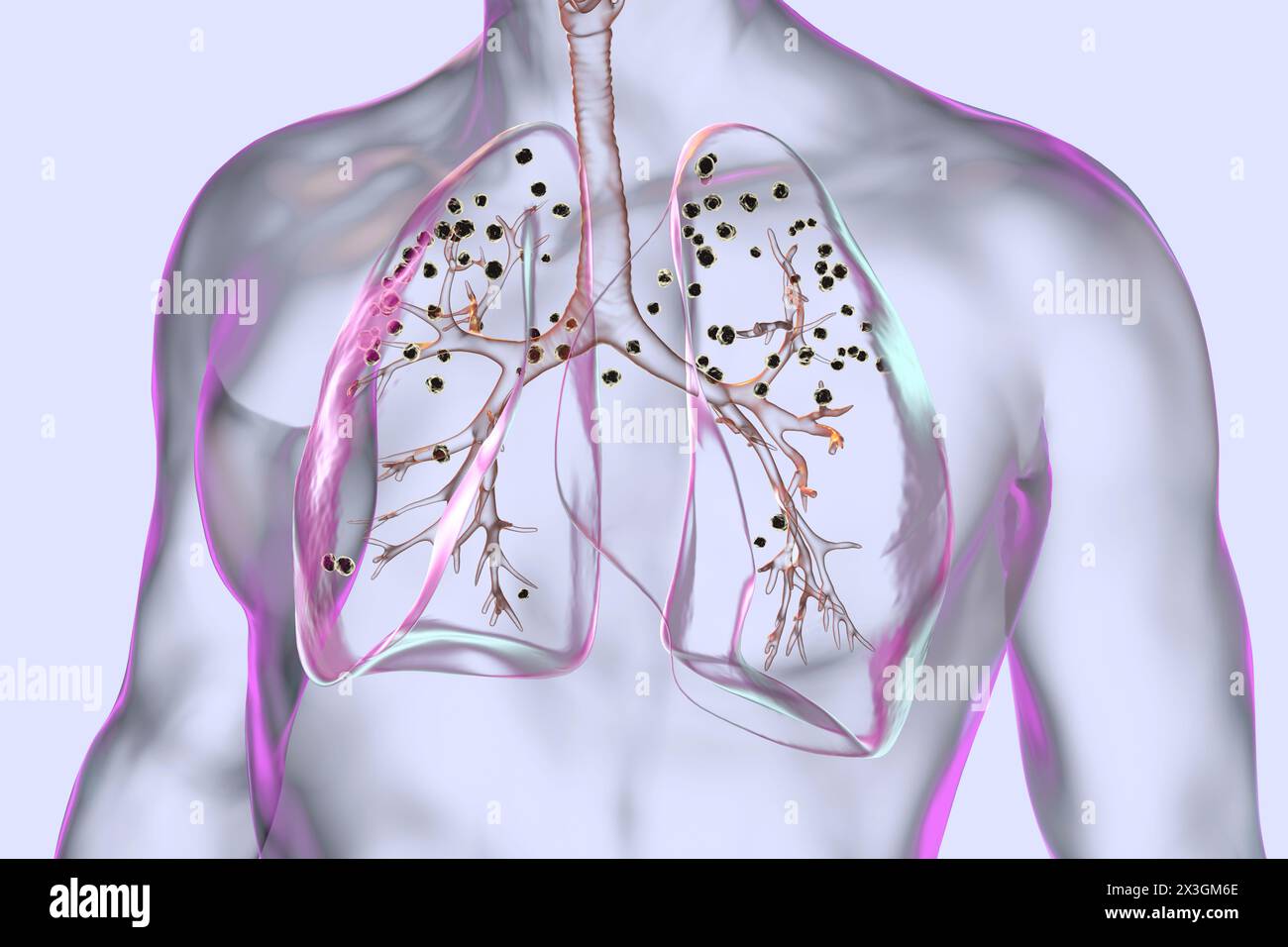 Silicotic hi-res stock photography and images - Alamy