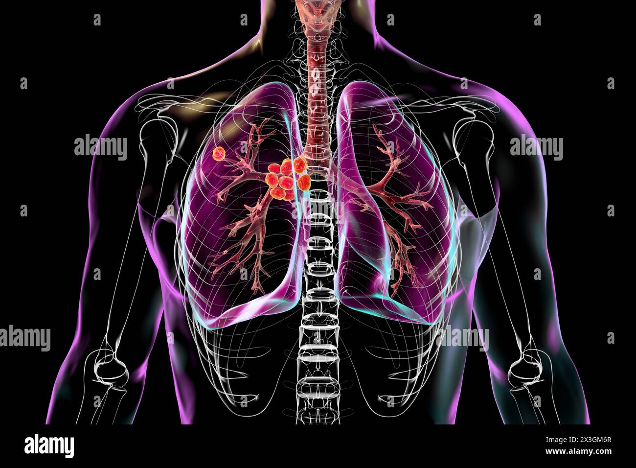 Primary lung tuberculosis hi-res stock photography and images - Alamy