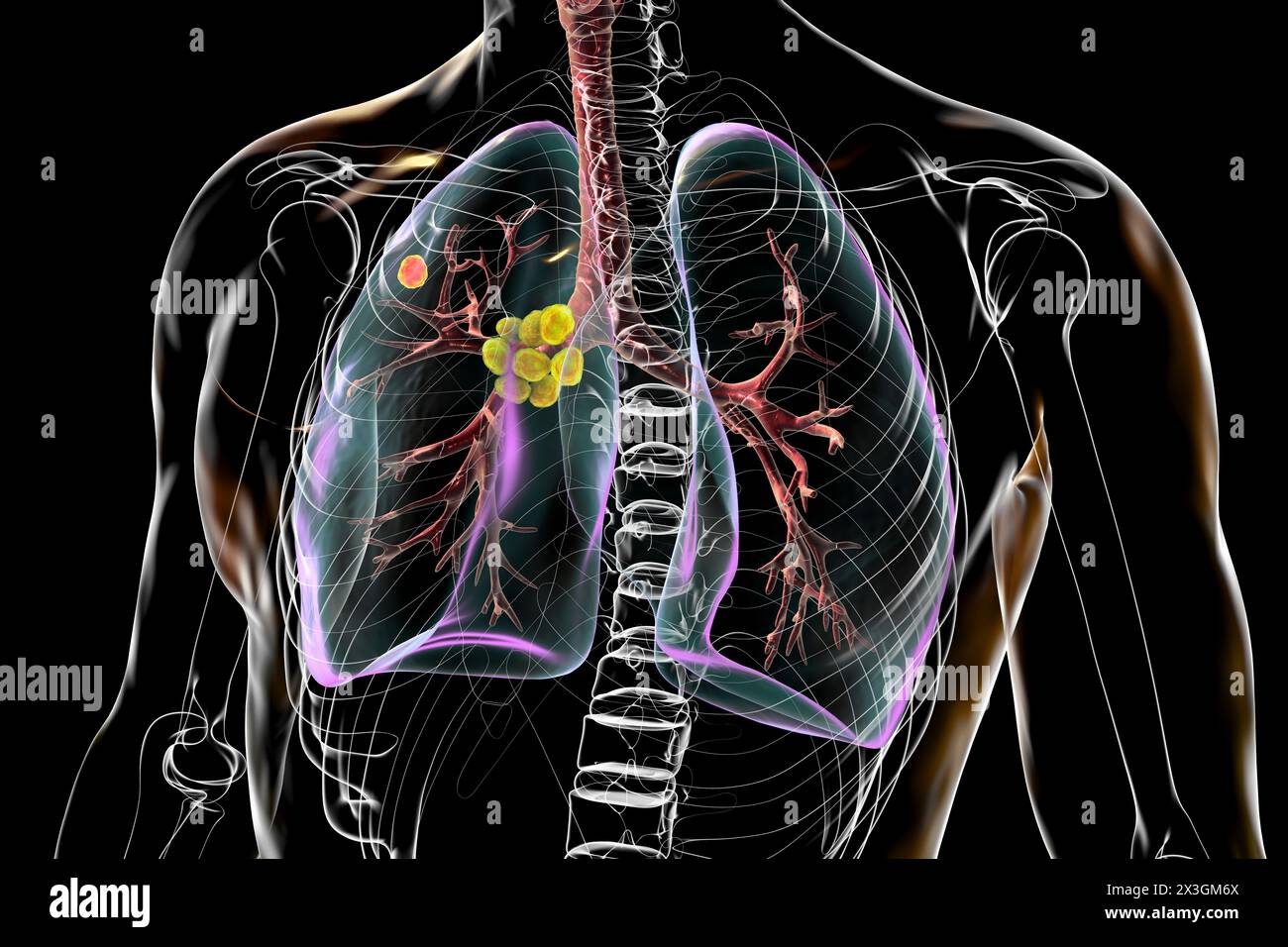 Illustration of primary lung tuberculosis, featuring the Ghon complex ...