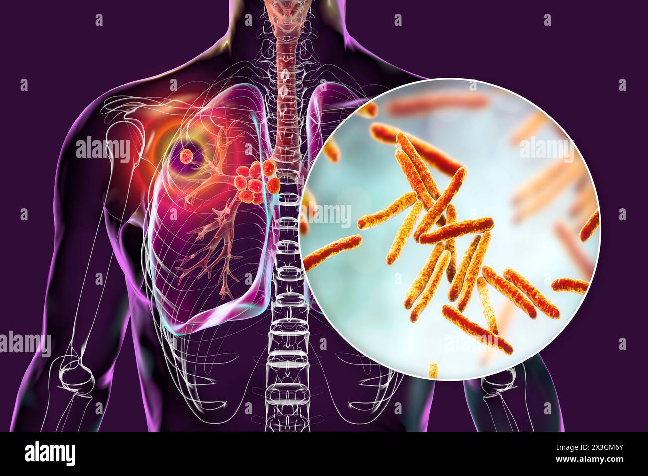 Illustration of primary lung tuberculosis, featuring the Ghon complex ...
