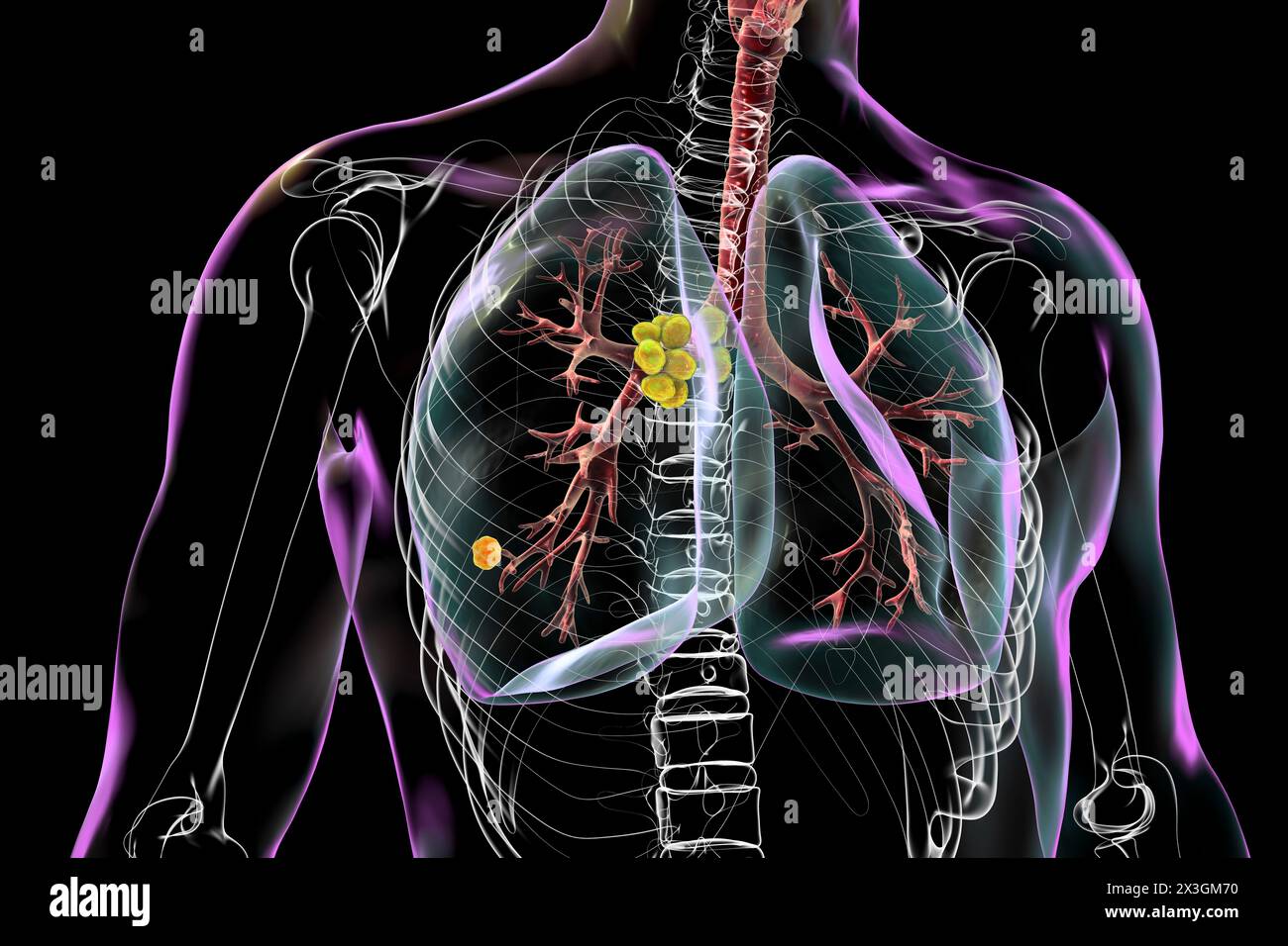 Illustration of primary lung tuberculosis, featuring the Ghon complex ...