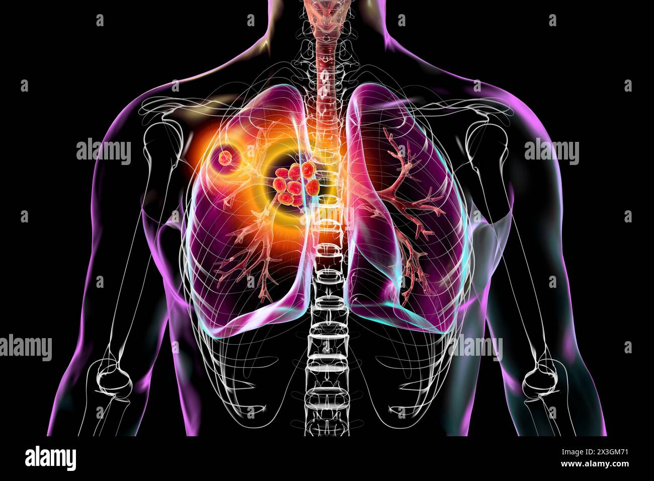 Illustration of primary lung tuberculosis, featuring the Ghon complex ...
