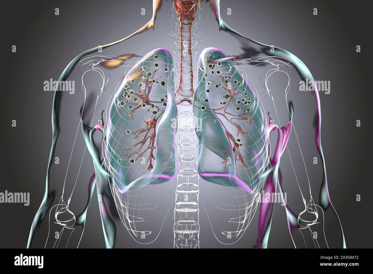 Illustration depicting lungs affected by silicosis within a transparent ...