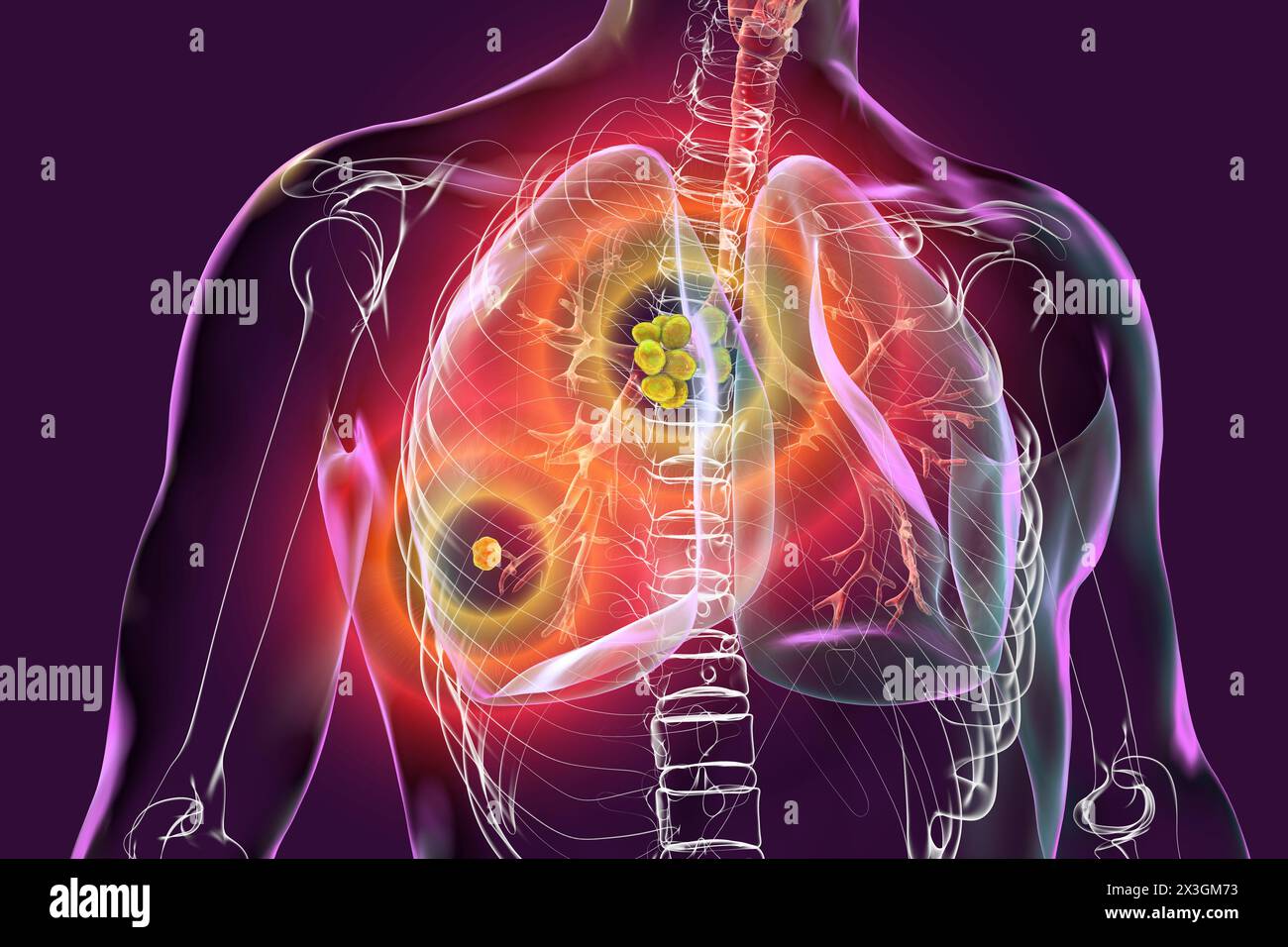 Illustration of primary lung tuberculosis, featuring the Ghon complex ...