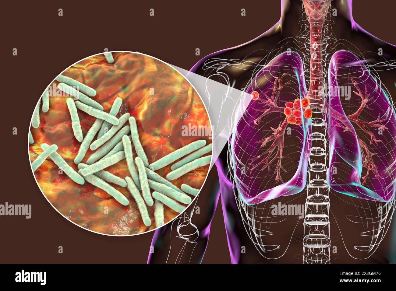 Illustration of primary lung tuberculosis, featuring the Ghon complex ...