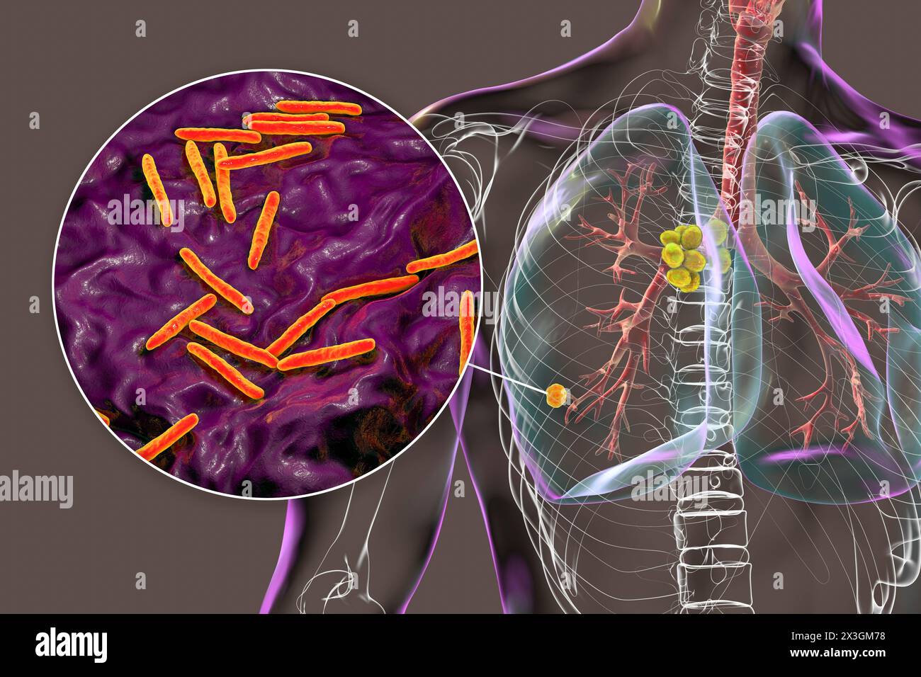 Illustration of primary lung tuberculosis, featuring the Ghon complex ...