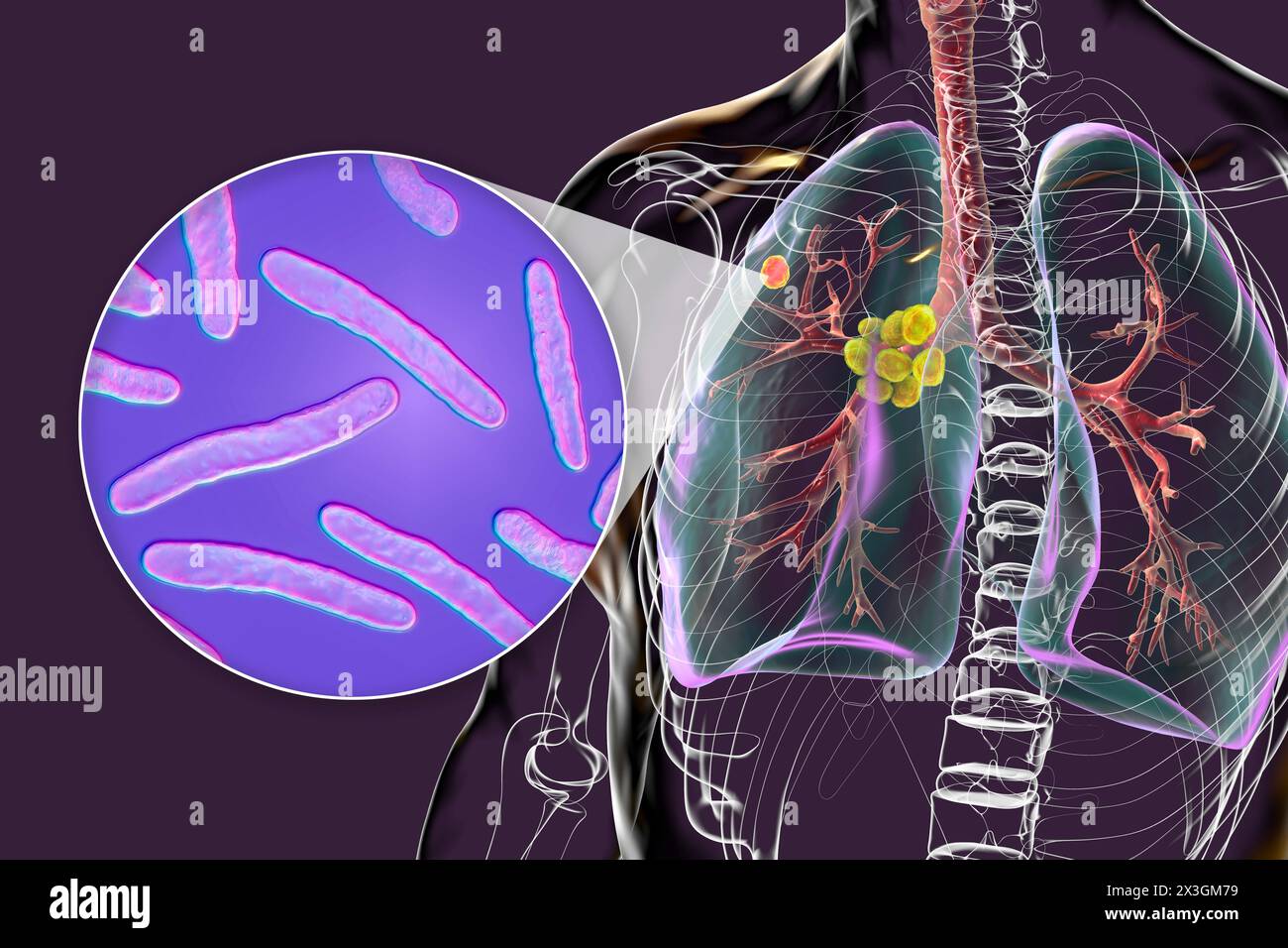 Illustration of primary lung tuberculosis, featuring the Ghon complex and mediastinal ...