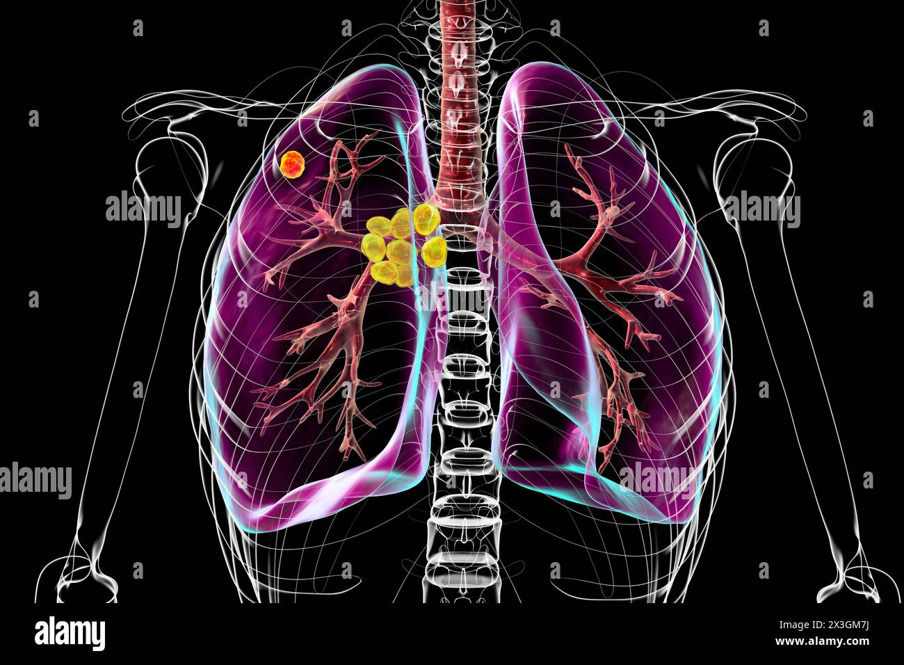 Illustration of primary lung tuberculosis, featuring the Ghon complex ...