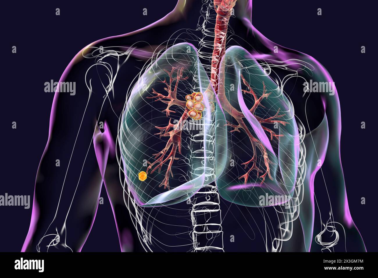 Illustration of primary lung tuberculosis with the Ranke complex ...