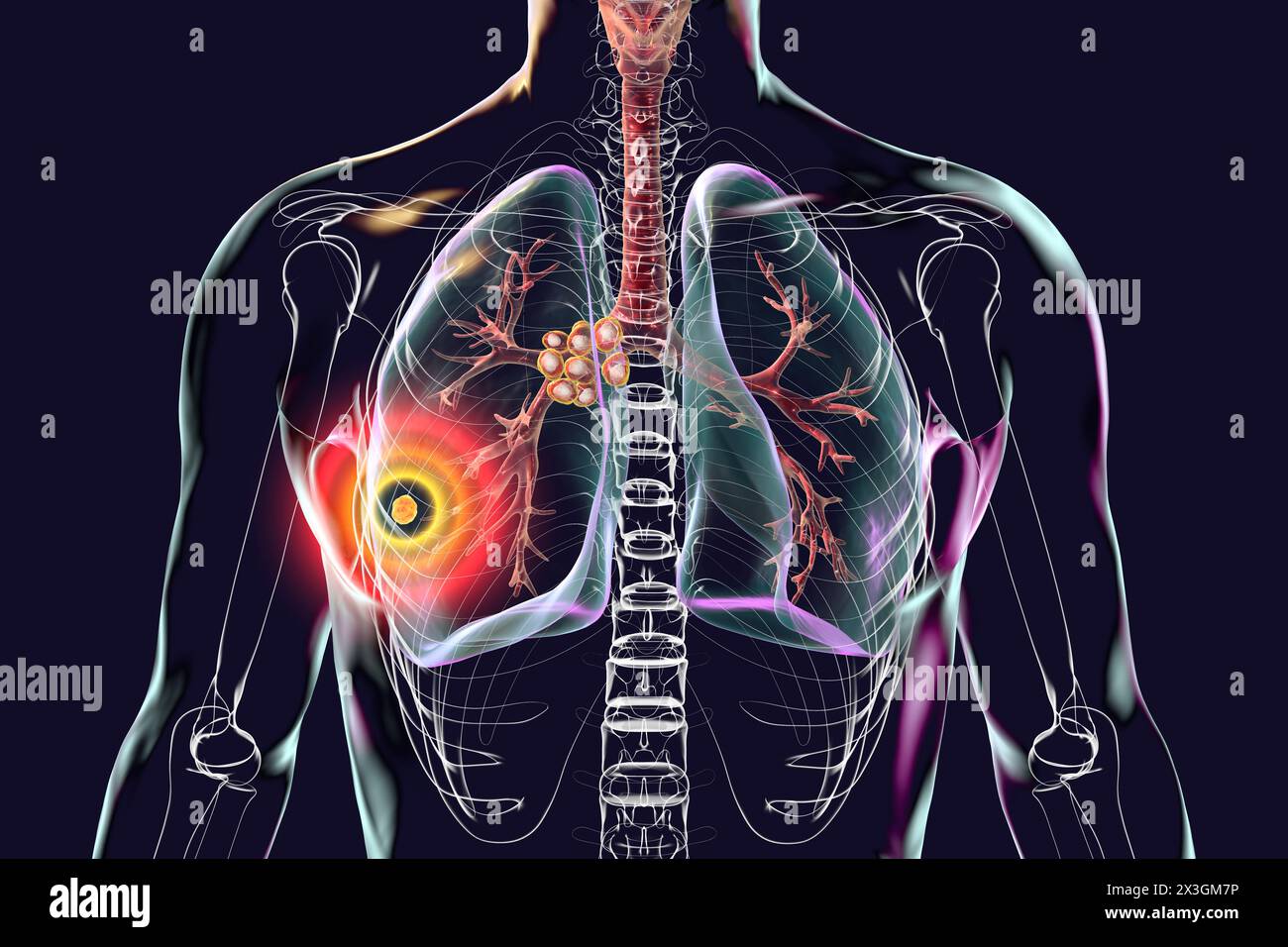 Primary lung tuberculosis with ranke complex hi-res stock photography ...