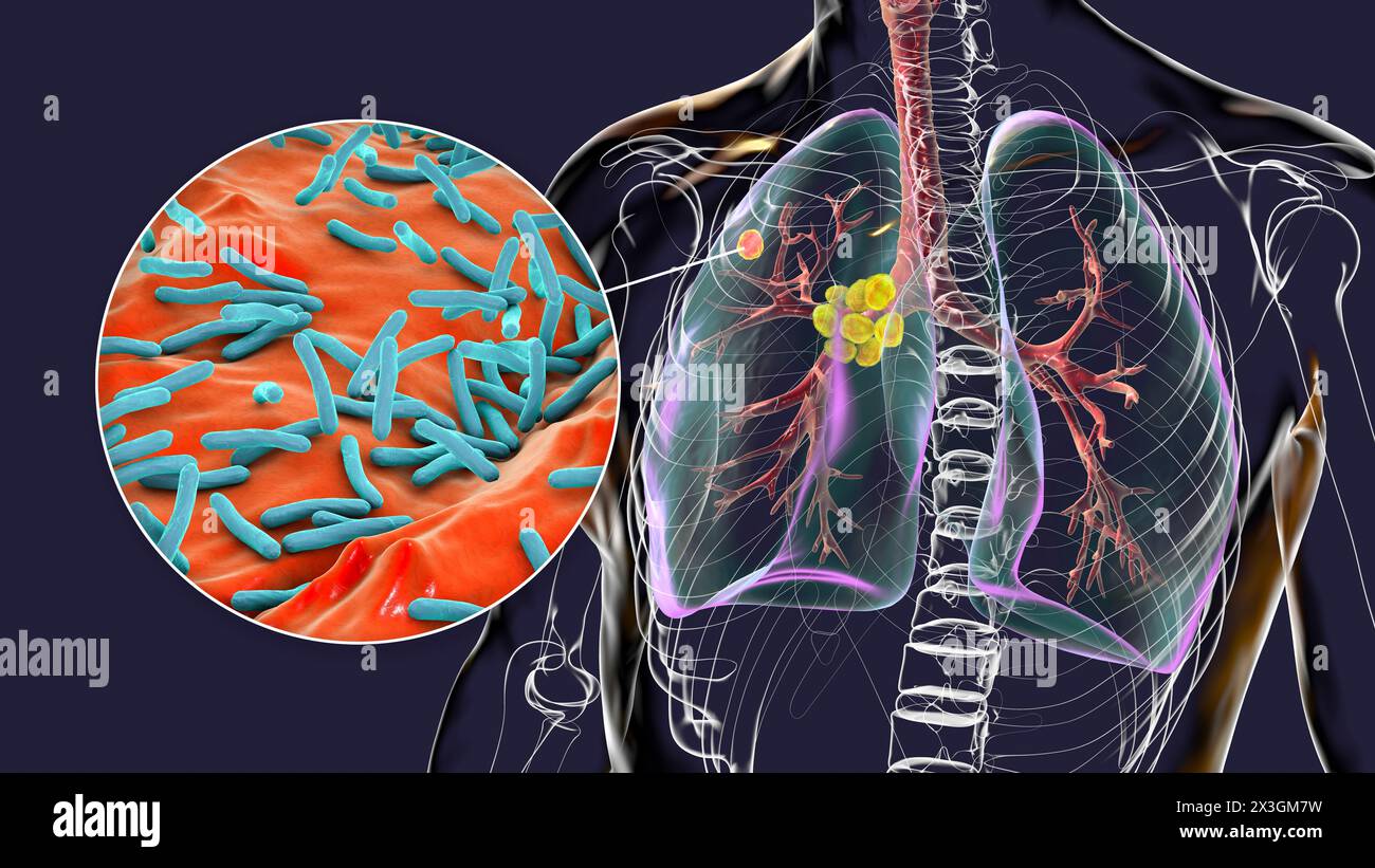 Illustration of primary lung tuberculosis, featuring the Ghon complex ...