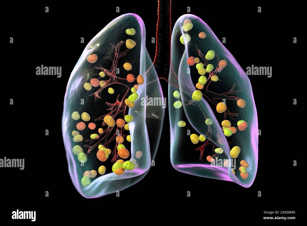 Illustration of lung histoplasmosis, a fungal infection caused by ...