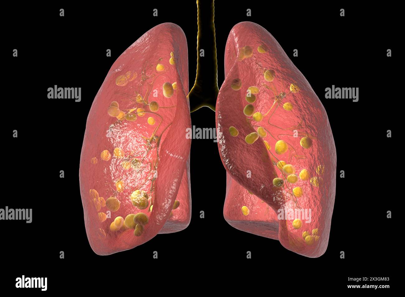 Illustration of lung histoplasmosis, a fungal infection caused by ...