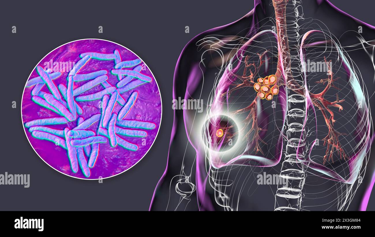 Illustration of primary lung tuberculosis with the Ranke complex ...