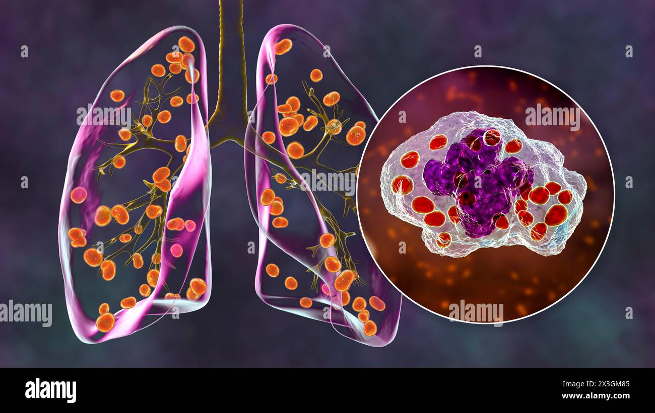 Illustration of lung histoplasmosis, a fungal infection caused by ...