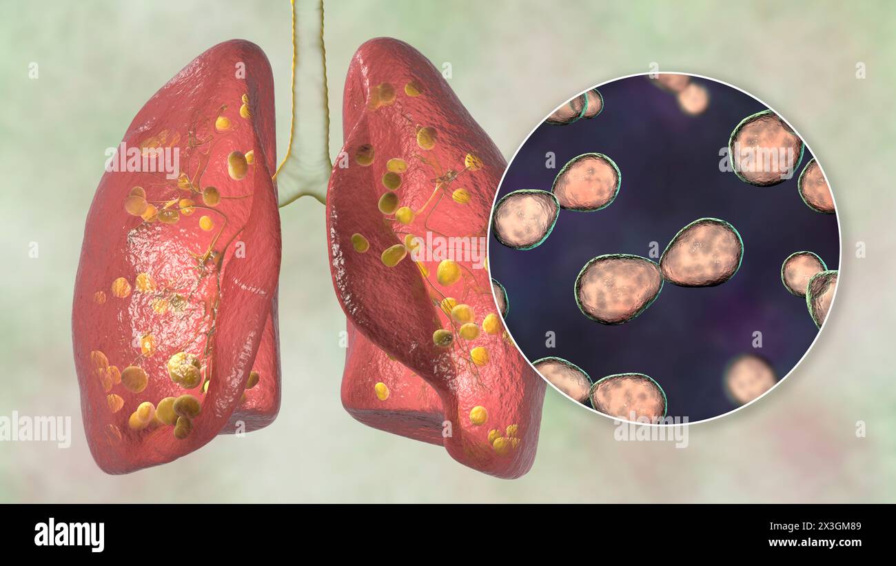 Illustration of lung histoplasmosis, a fungal infection caused by ...