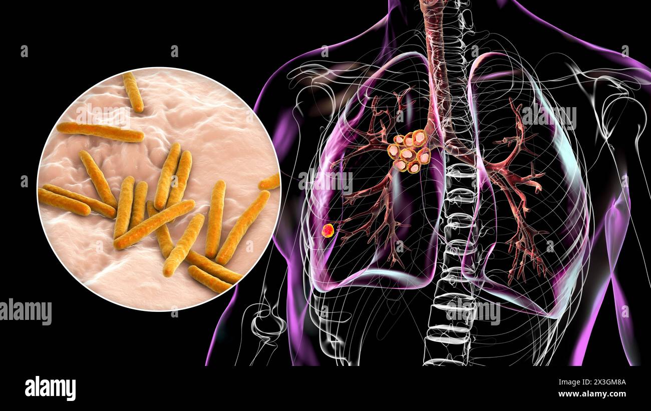 Microbial lesions hi-res stock photography and images - Alamy