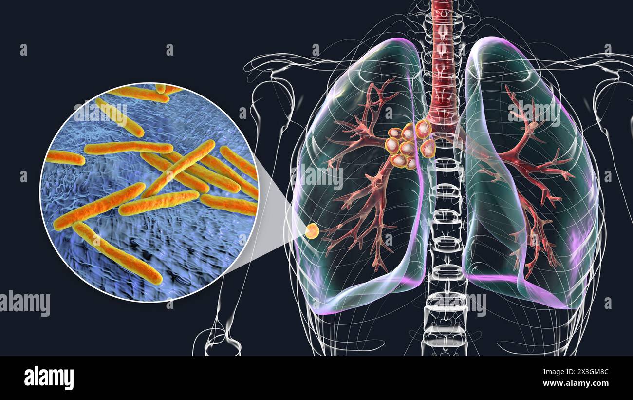 Microbial lesions hi-res stock photography and images - Alamy