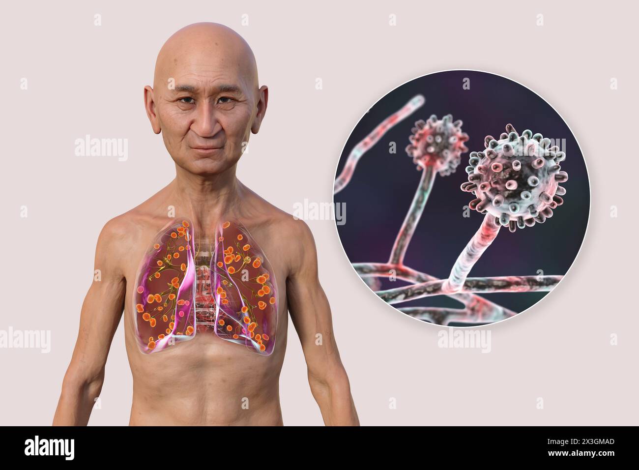 Illustration of lung histoplasmosis, a fungal infection caused by Histoplasma capsulatum ...