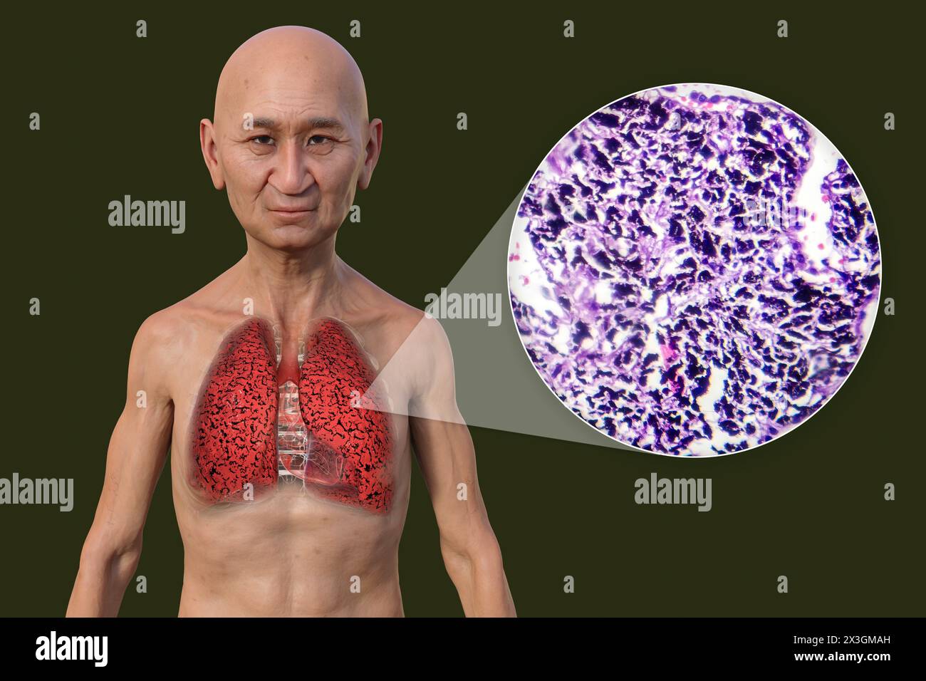 Illustration of a man with smoker's lungs, along with a micrograph ...