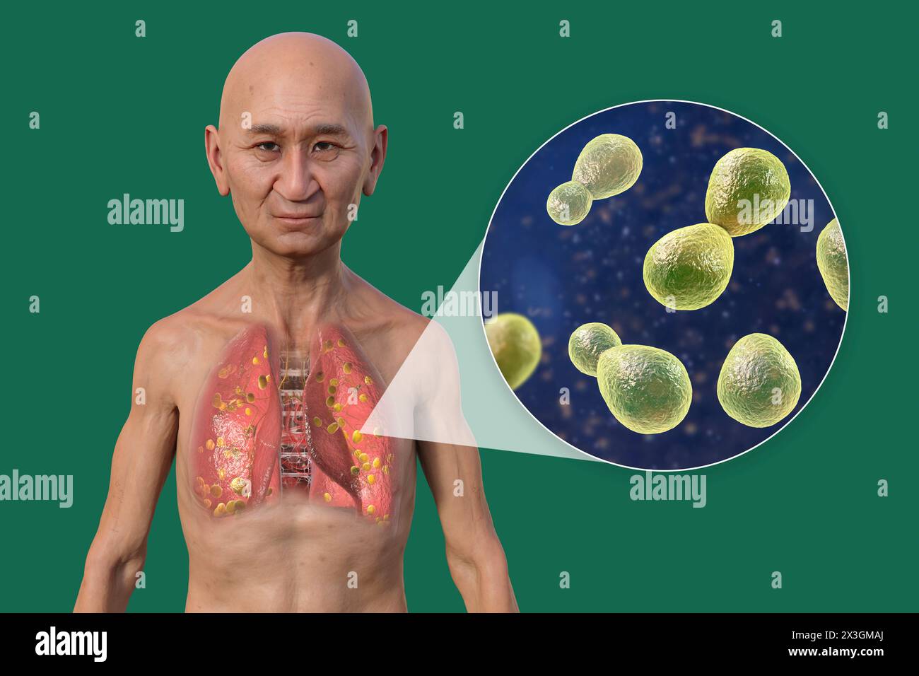 Illustration of lung histoplasmosis, a fungal infection caused by ...