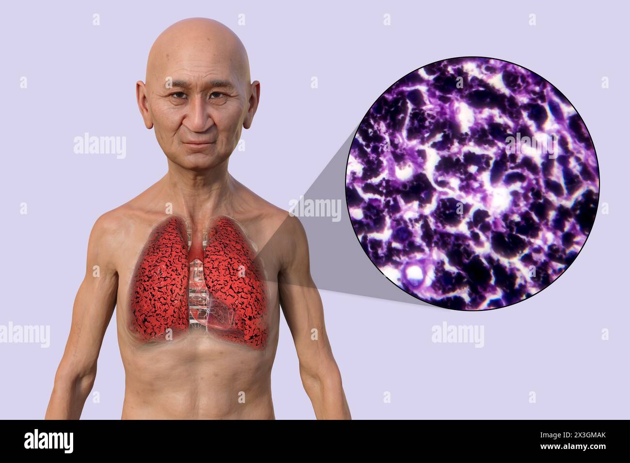 Illustration of a man with smoker's lungs, along with a micrograph ...