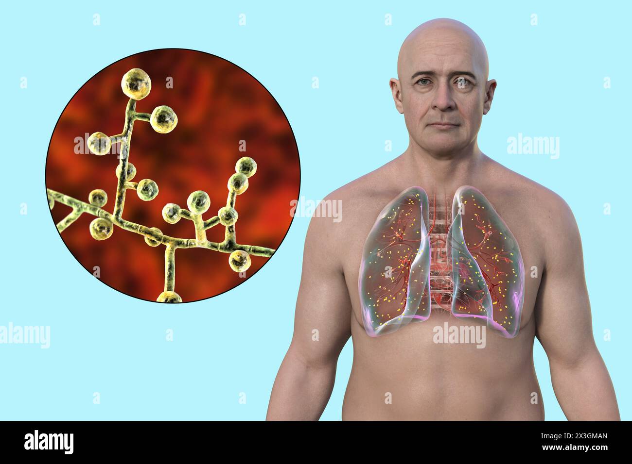 Illustration of a man with lung adiaspiromycosis, a respiratory ...