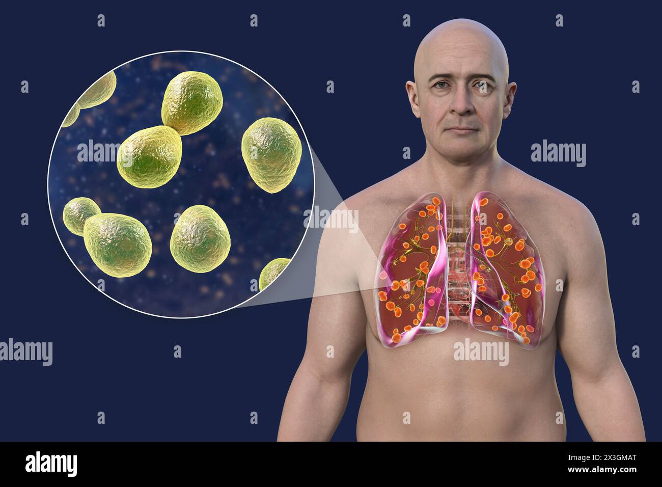 Illustration of a man with lung histoplasmosis, a fungal infection ...