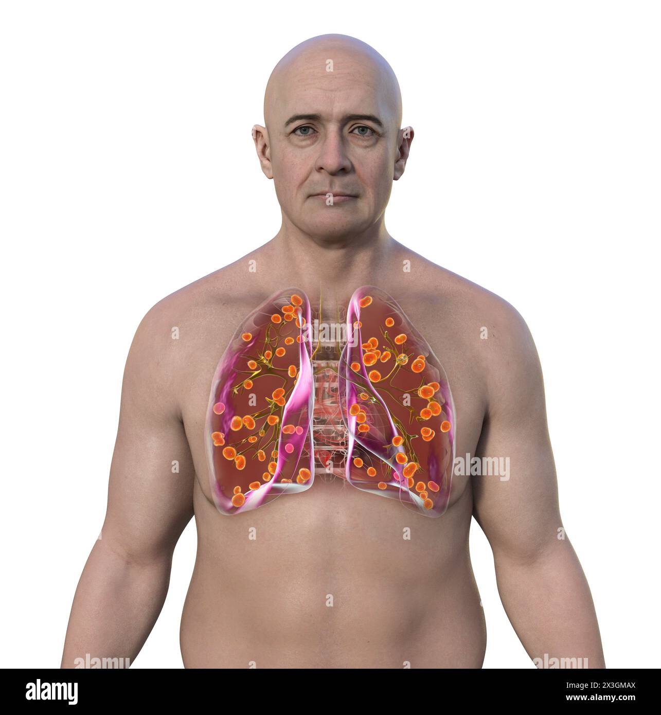 Illustration of a man with lung histoplasmosis, a fungal infection ...