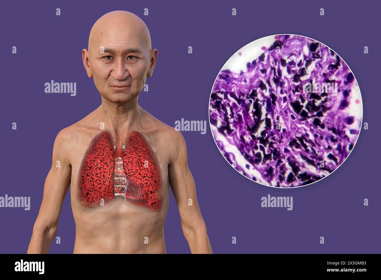 Illustration of a man with smoker's lungs, along with a micrograph ...