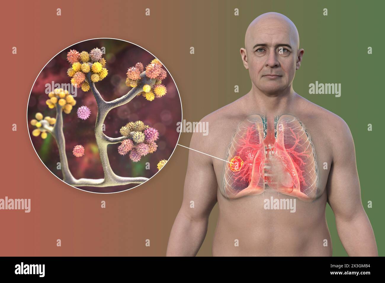 Illustration of a man with a lung mucormycosis lesion and a close-up ...