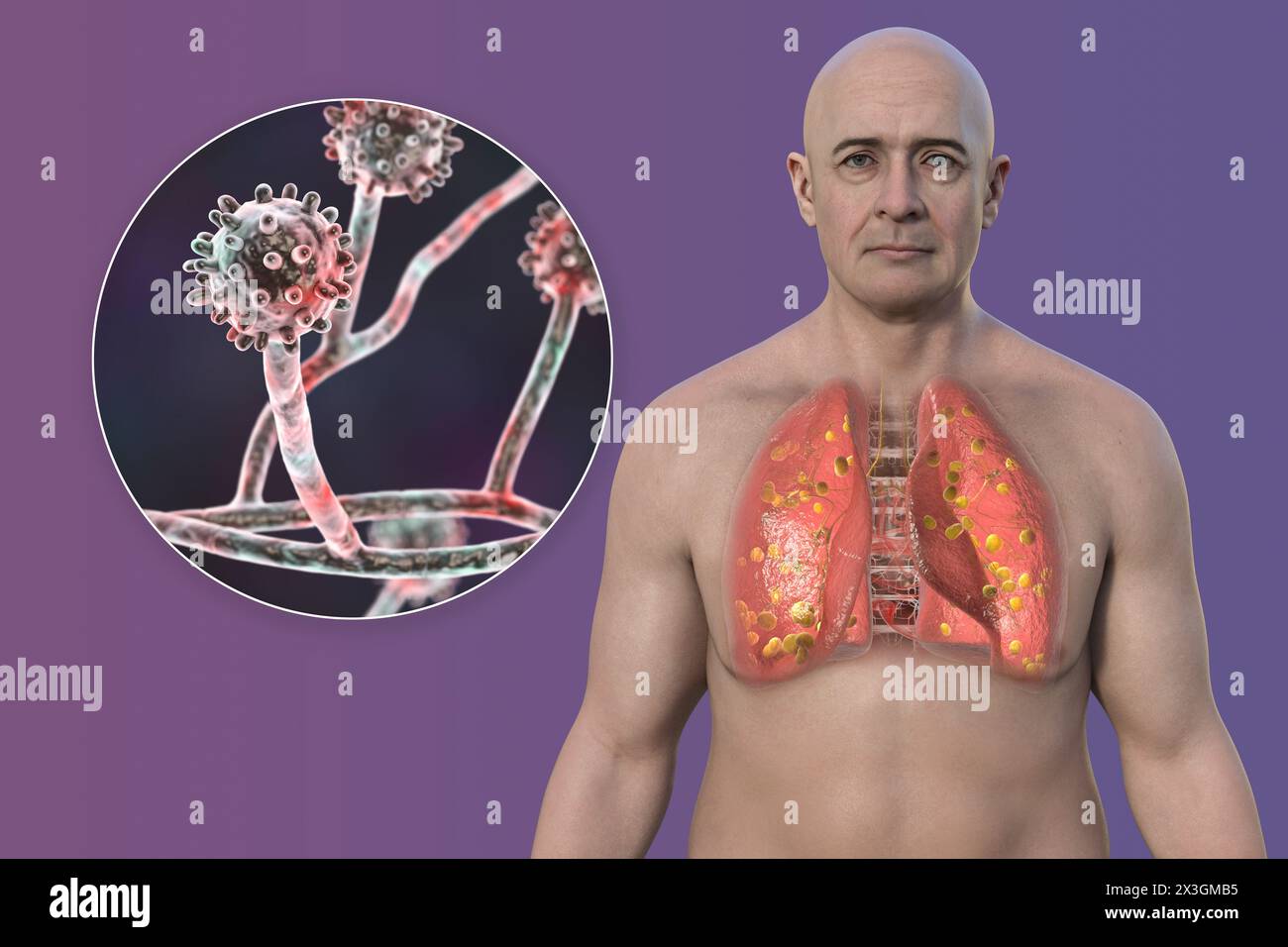 Illustration of a man with lung histoplasmosis, a fungal infection ...