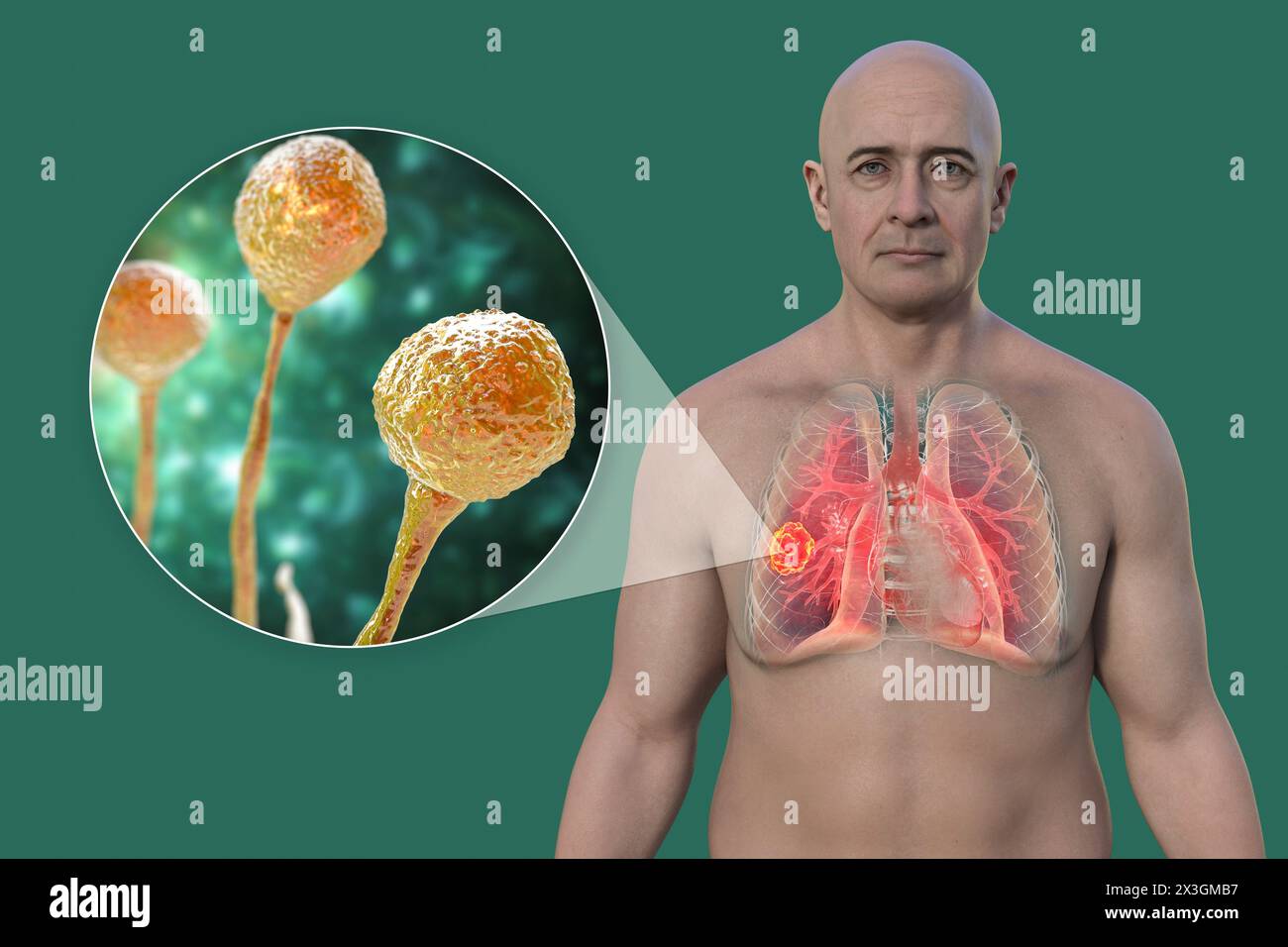 Illustration of a man with a lung mucormycosis lesion and close-up view ...