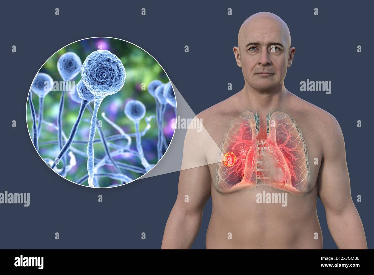 Illustration of a man with a lung mucormycosis lesion and close-up view ...