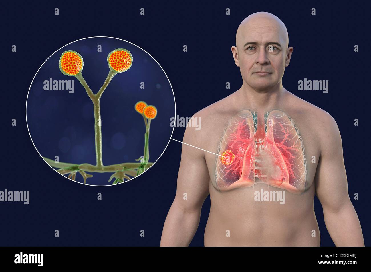 Illustration of a man with a lung mucormycosis lesion and close-up view ...