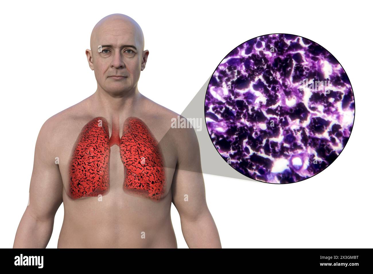 Illustration of a man with smoker's lungs, along with a micrograph ...