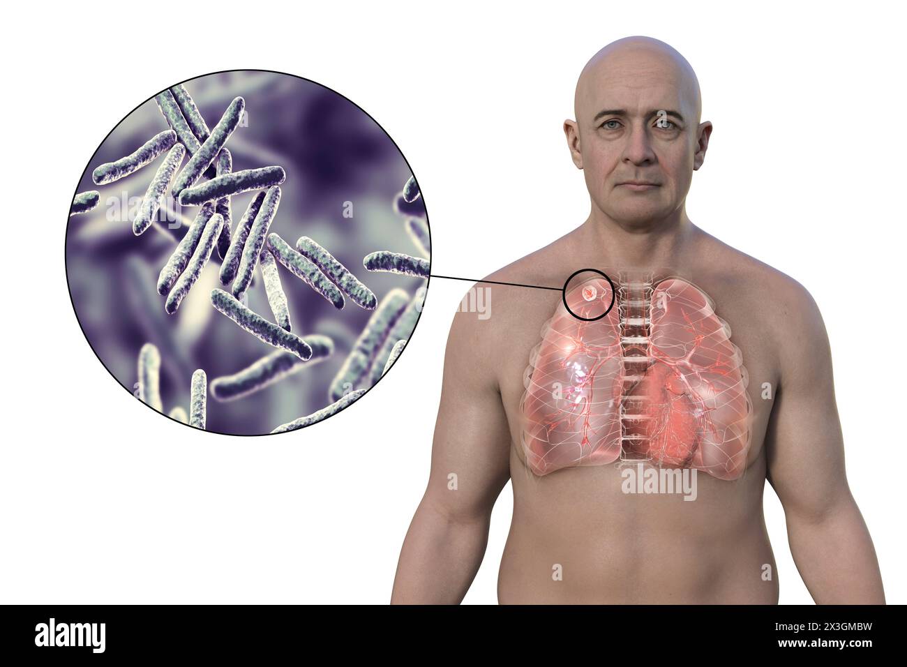 Illustration of a man with lungs affected by secondary tuberculosis and ...