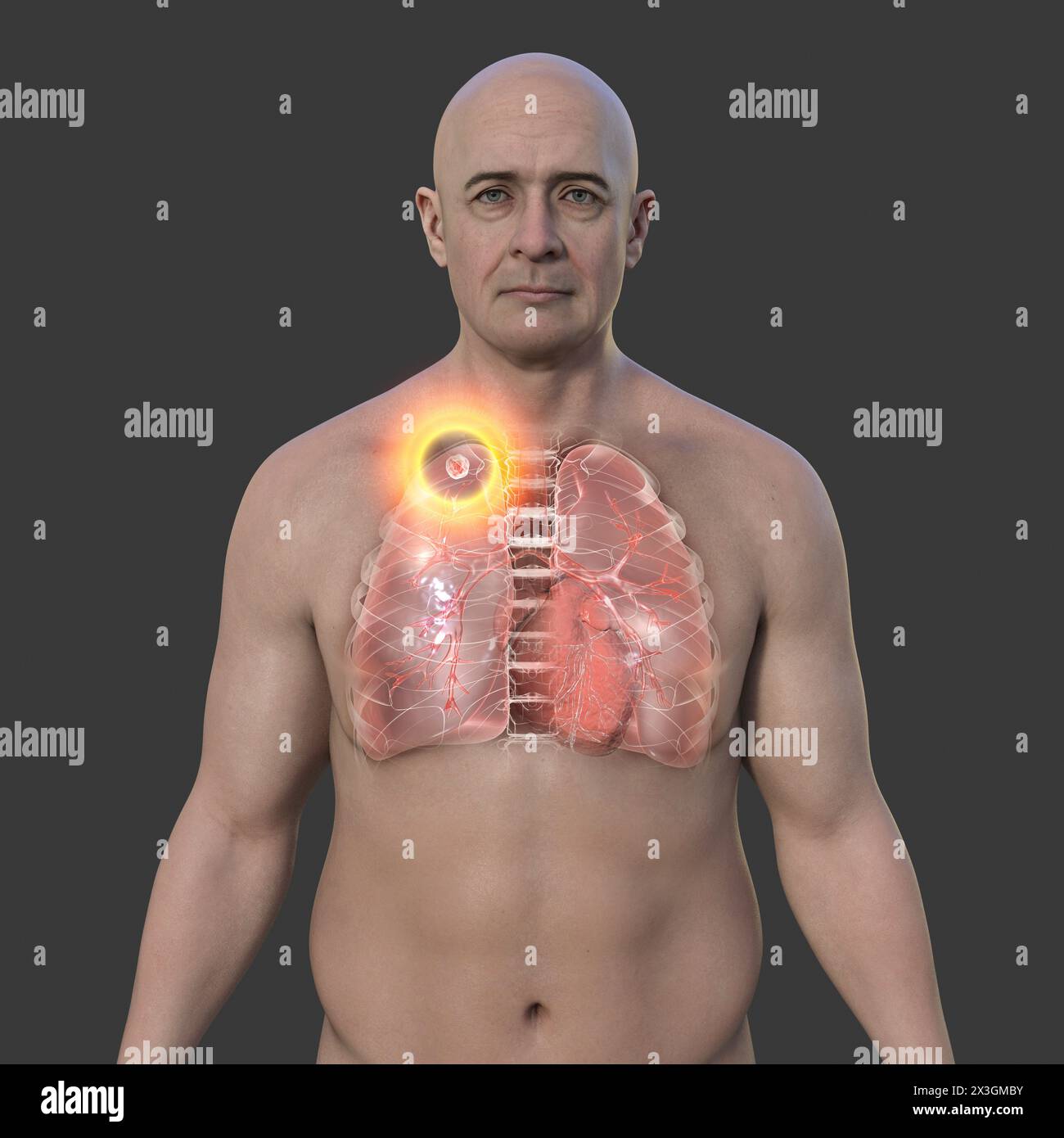 Illustration of a man with lungs affected by secondary tuberculosis ...