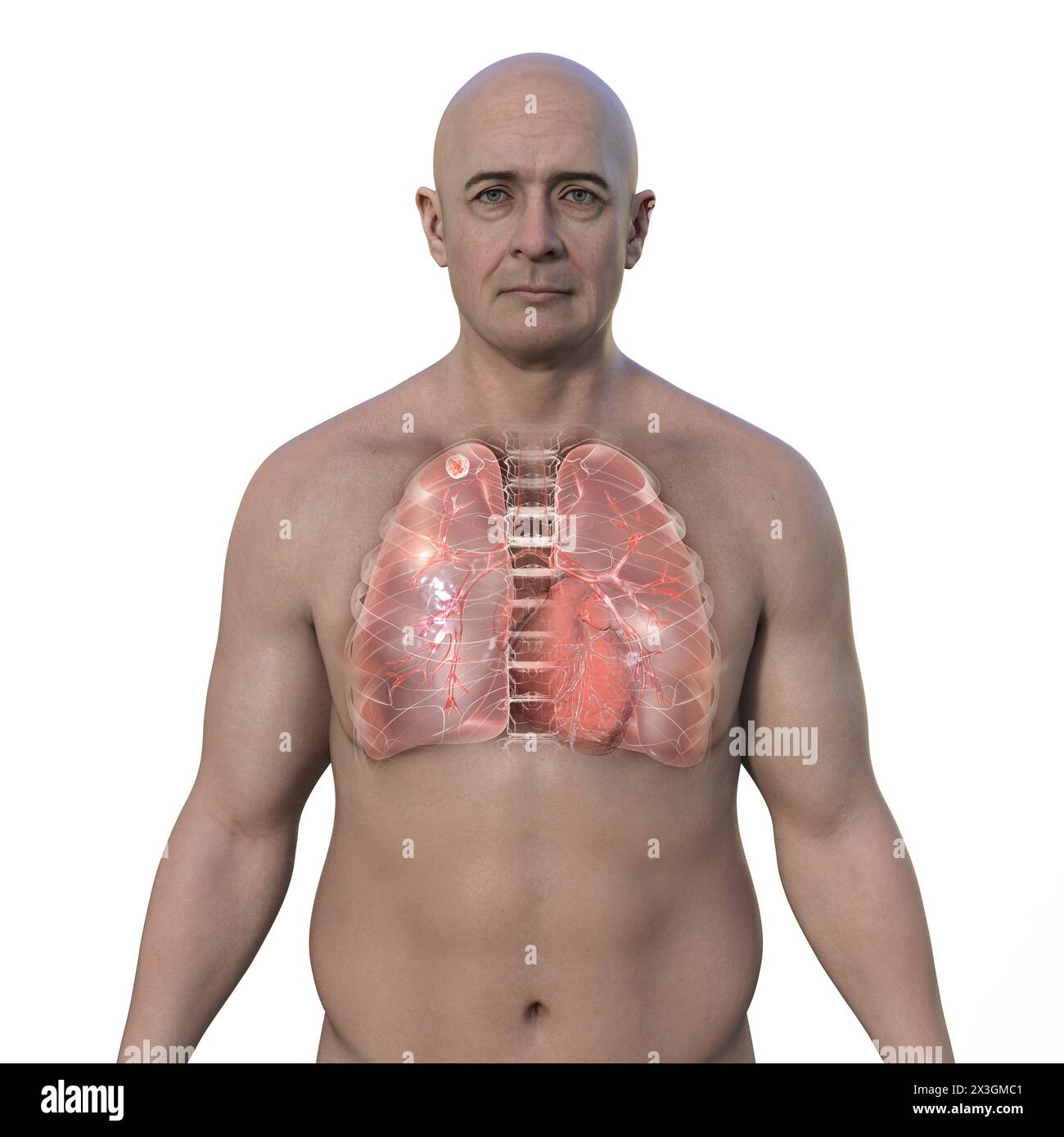 Illustration of a man with lungs affected by secondary tuberculosis ...